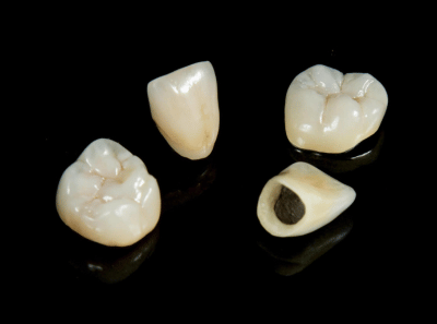 What Is a Porcelain Fused to Metal Dental Crown?