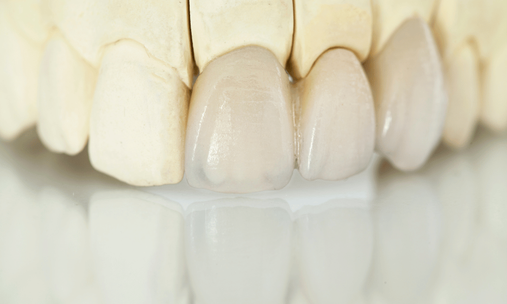 Zirconia Crown Prep