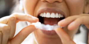 Hard Acrylic Night Guard | PRO-Craft Dental Lab