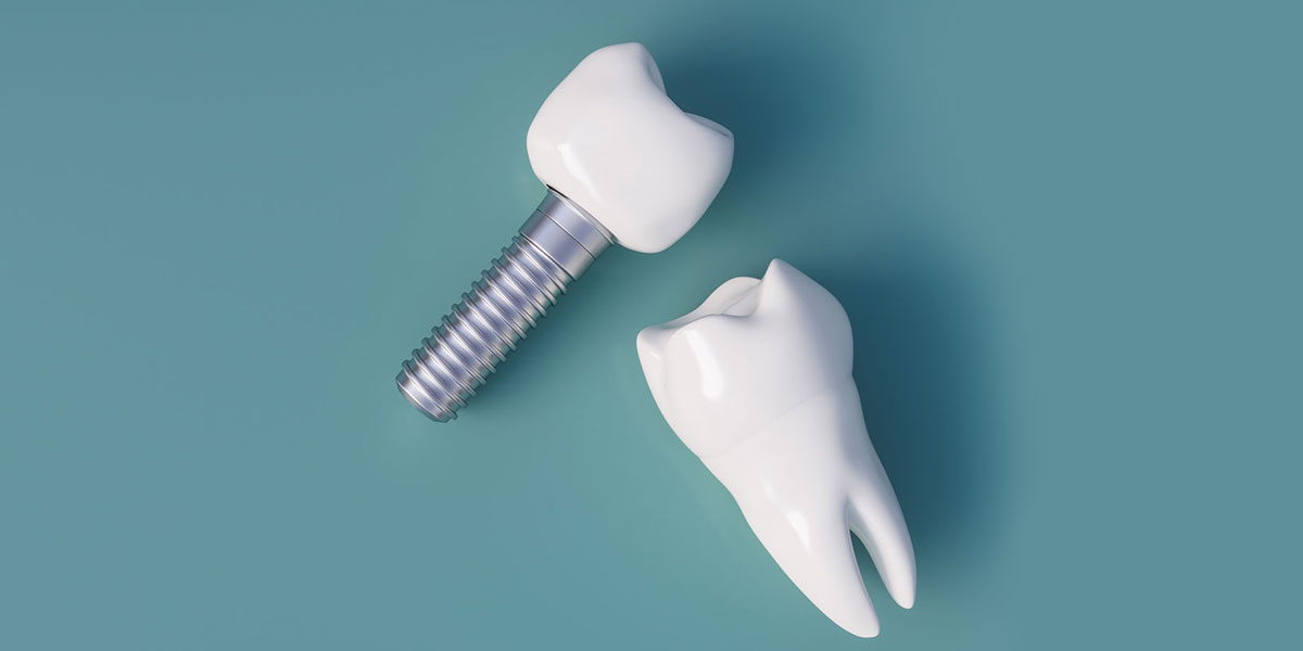 Dental Implant Lab - Implant Solutions | PRO-Craft Dental Laboratory